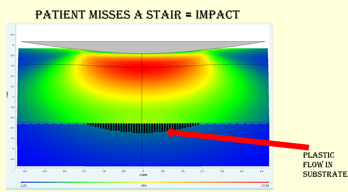 Implants of a lifetime – Saxonian Institute of Surface Mechanics – SIO